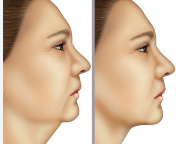 Pescoço e Papada - Dr. Marcio Grave