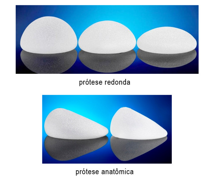 Aumento de mamas com implante de Silicone - Dr. Marcio Grave